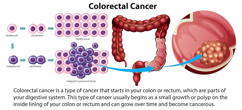 El Cáncer de Colon: Un Análisis Profundo de una Enfermedad Alarmante ...